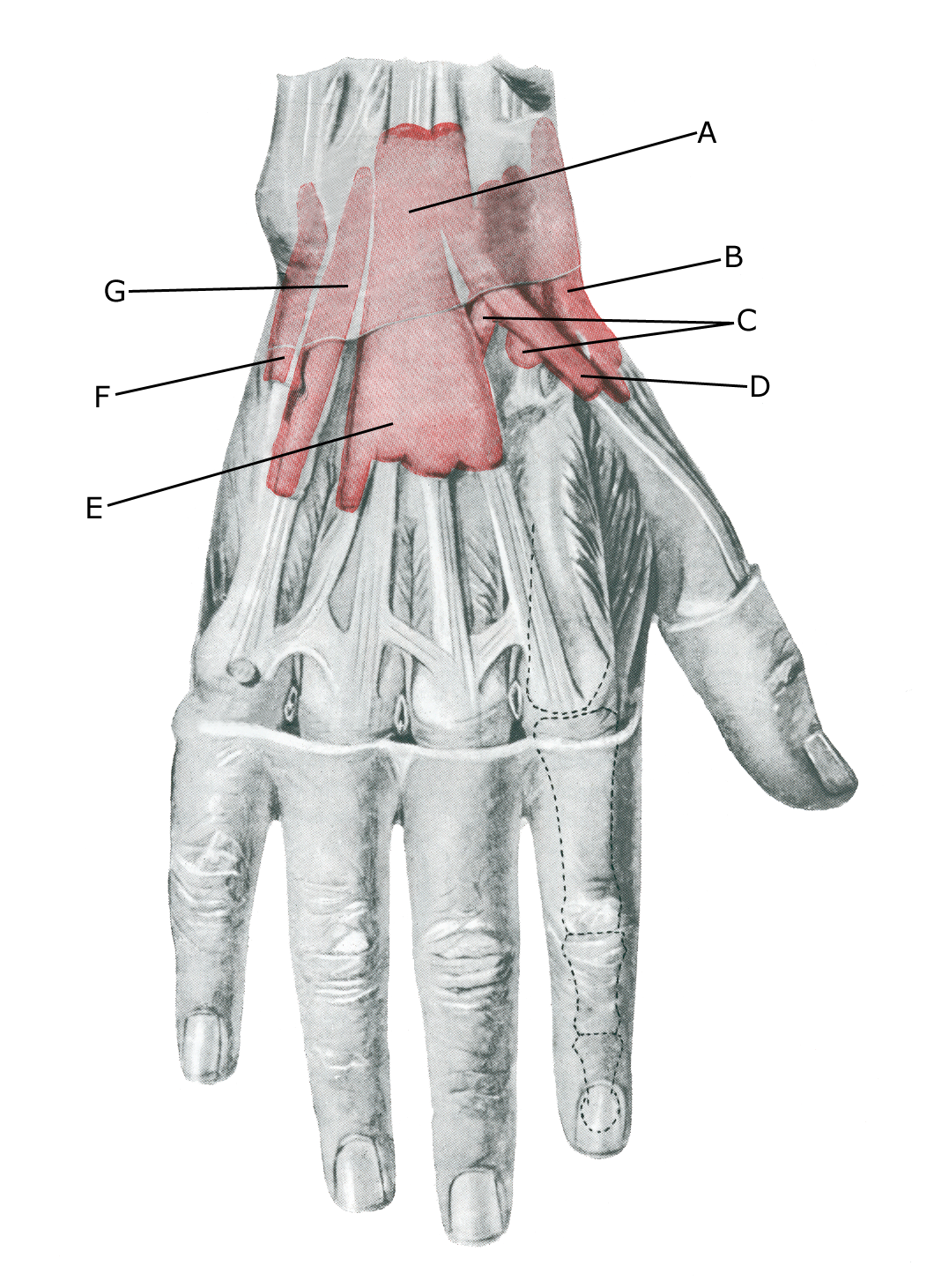 Inflammation of the tendon sheath on the outer wrist - Sportnetdoc.dk